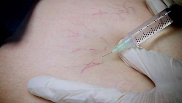 Sclerotherapy (Spider vein injections) - Elìd Medical Aesthetics