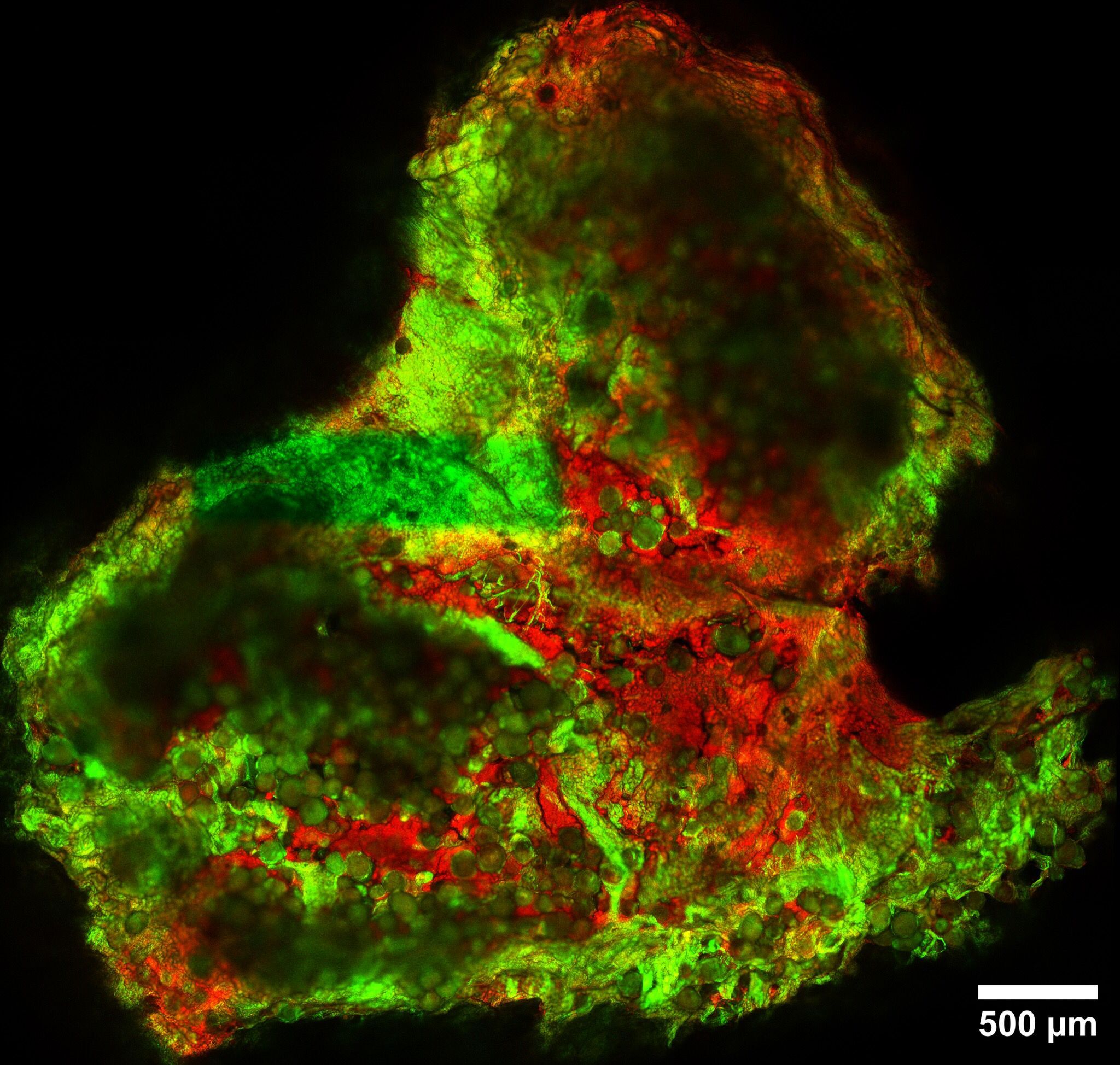 Detecting Cancerous Brain Cells - collapsing wavefunctions