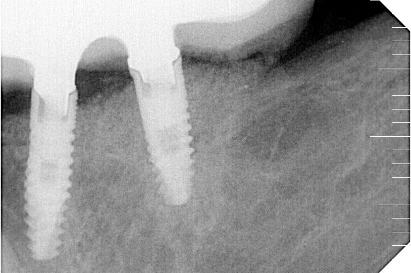 Controlled implantoplasty for predictable reosseointegration