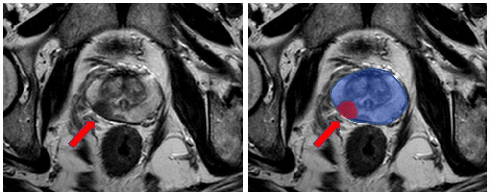 Prostate cancer check, assessment and treatment - Kent Prostate Clinic