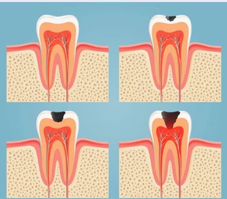 What is tooth decay? - Satyam Dental Care