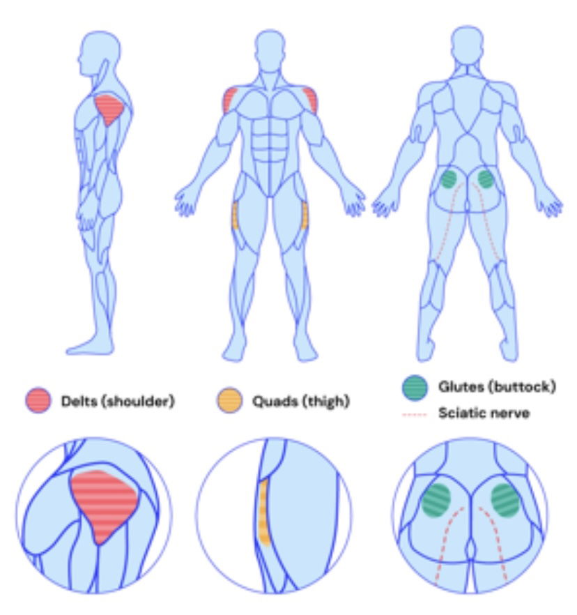 Steroid Injection Step-By-Step - Syntrax UK